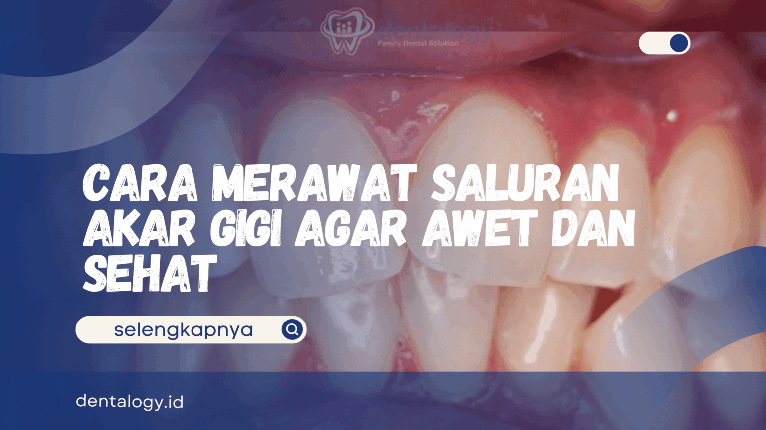 Cara Merawat Saluran Akar Gigi Agar Awet dan Sehat