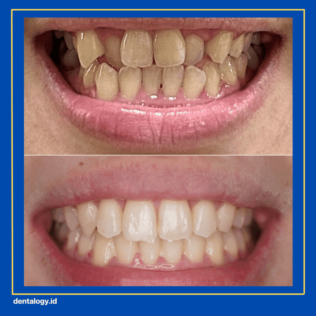 Kenali Penyebab Gusi Hitam, Kebiasaan Berikut Sering Diabaikan